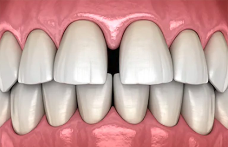 Dental Bonding - :- Dr Soto The Downey Dentist