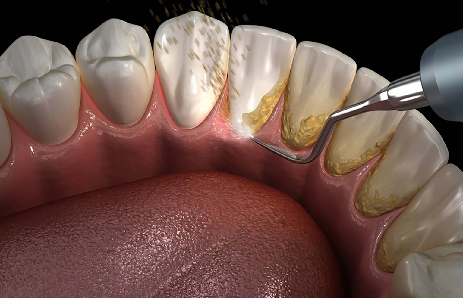Gingival Prevention - :- Dr Soto The Downey Dentist